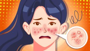 CBD Oil for Lupus: Is it Safe and Effective? - CFAH